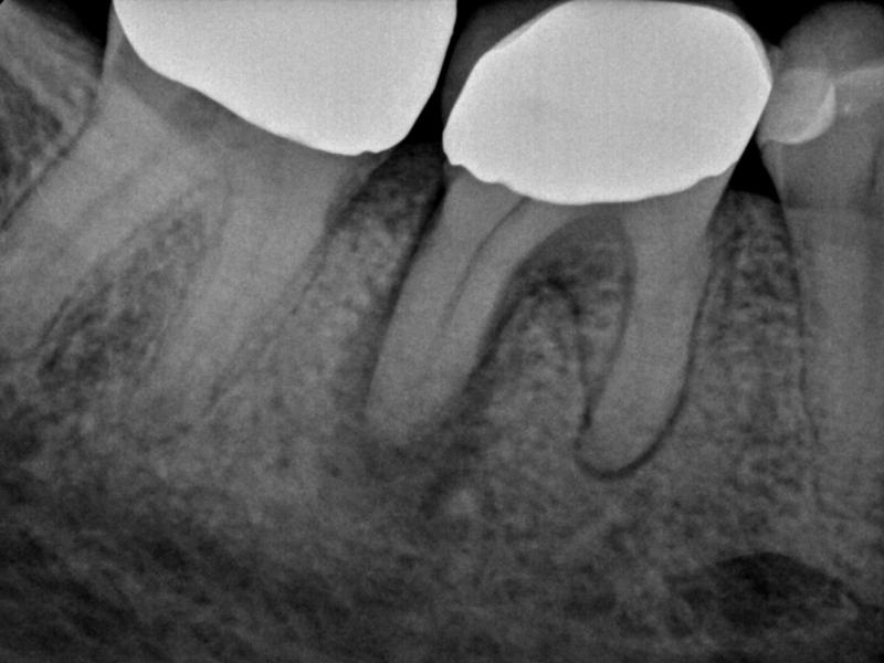 Guarded Pre Op With Healing Evidence Post Gentlewave® Procedure